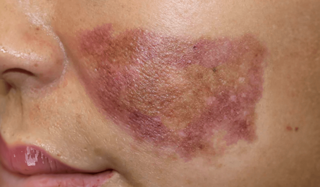 Hyperpigmentation - SkinEthos Clinic | Natural, Plant-Based & Non ...